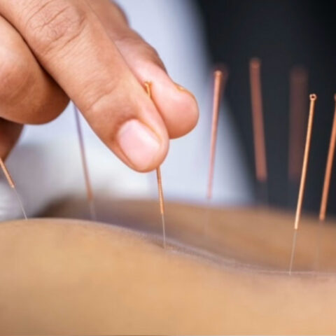 Acupuncture - Ling Shu MTC